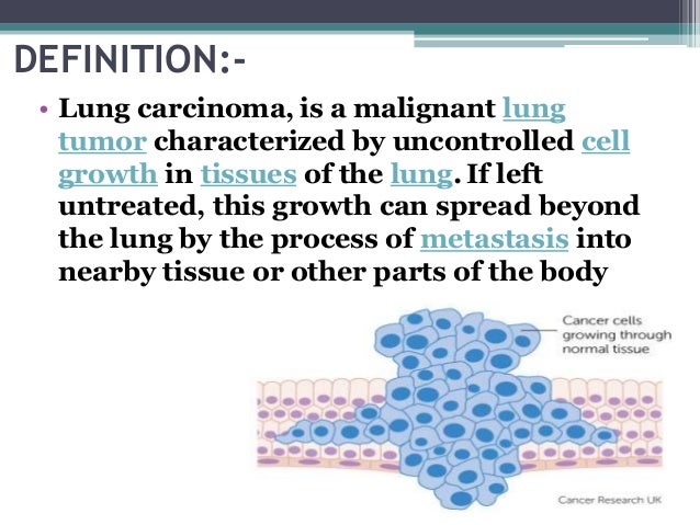 Lung Cancer Ppt