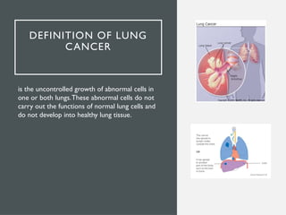 Lung_cancer_presentation- oncology .pptx