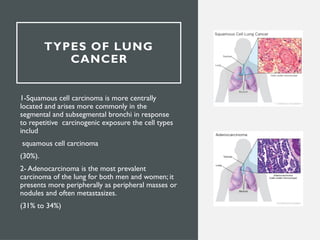 Lung_cancer_presentation- oncology .pptx