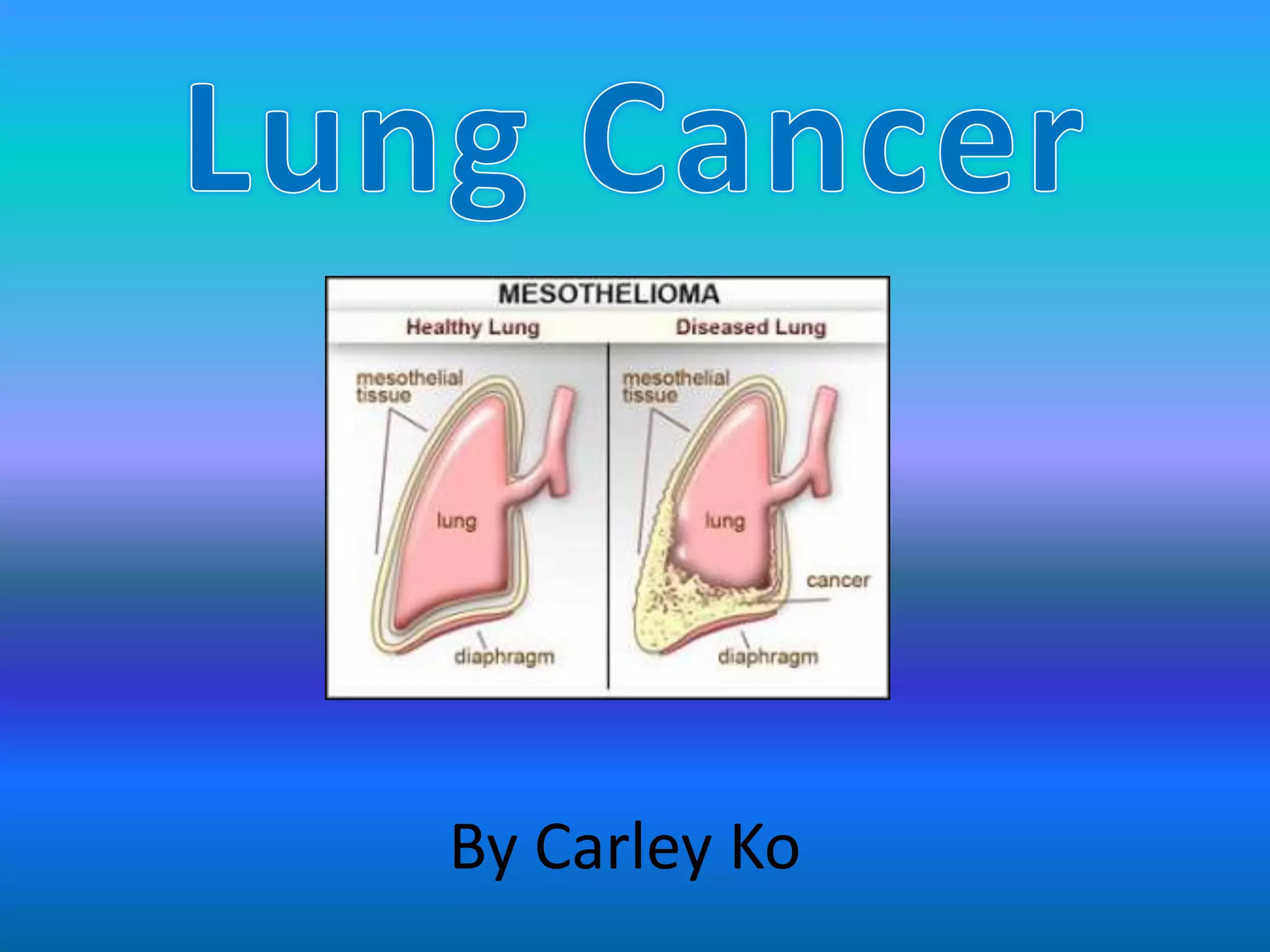 Lung cancers | PPTX
