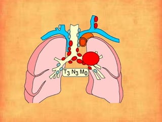 Lung cancer stage 3 symptoms and treatment methodologies | PPTX