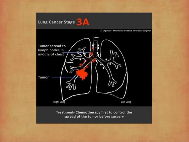 Lung cancer stage 3 symptoms and treatment methodologies