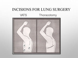 Lung Cancer Treatment: Surgery (Bangla) | PPT