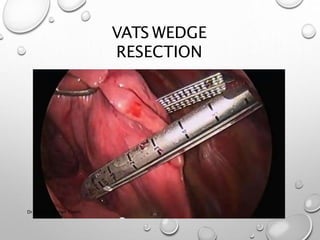 Lung Cancer Treatment: Surgery (Bangla) | PPT