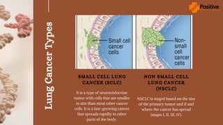 Lung Cancer Test Kit | Best Treatment Options | Advanced Cancer Testing ...