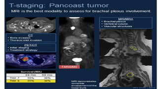 Lung Cancer TNM 8.pptx