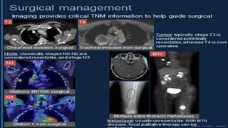 Lung Cancer TNM 8.pptx