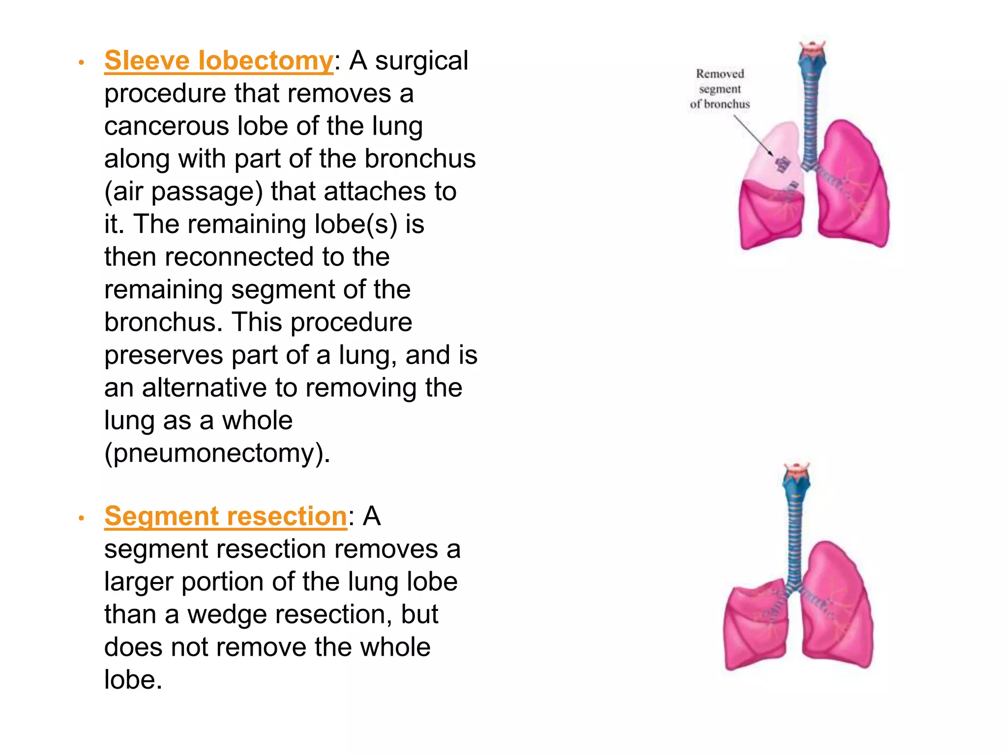 Lung cancer treatment | PPTX