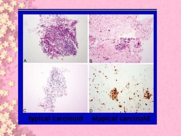 Lung carcinoid tumor | PPTX | Lung and Respiratory Health | Diseases ...