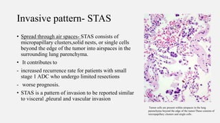 Lung carcinoma 2016 UPDATE | PPTX