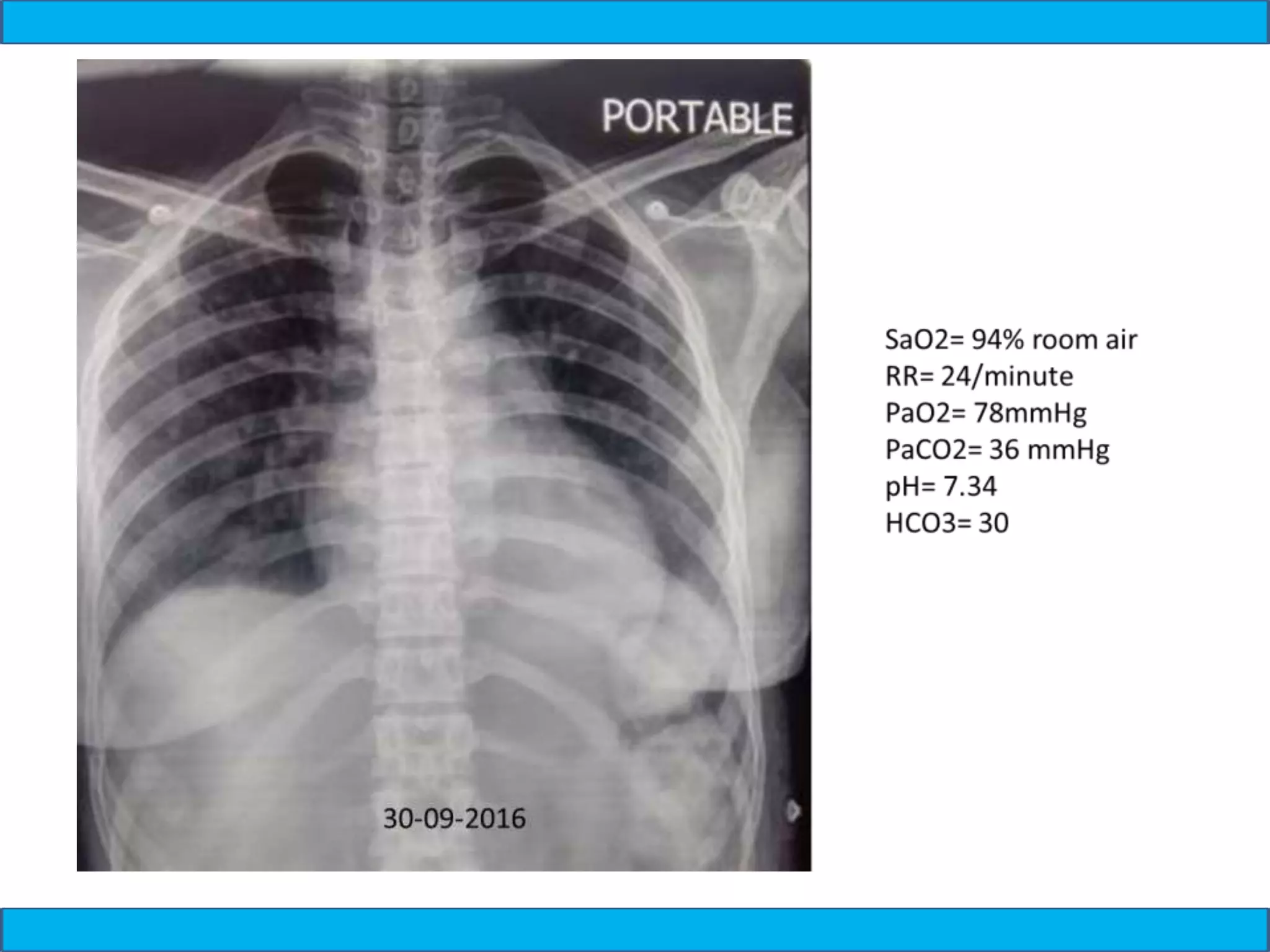 Lung contusion | PPTX