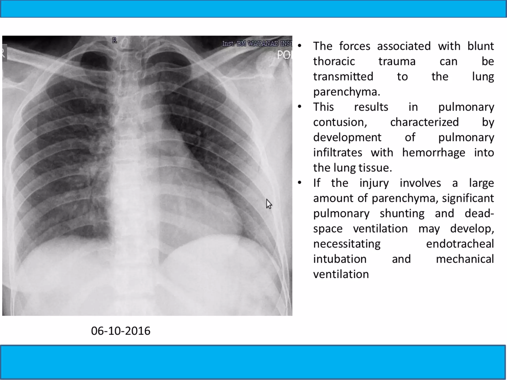 Lung contusion | PPTX