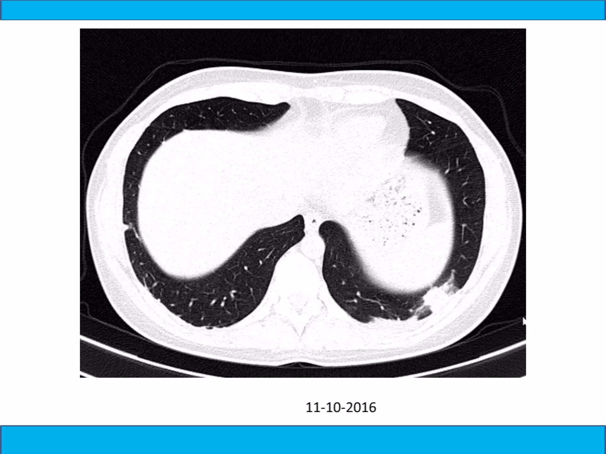 Lung contusion | PPTX