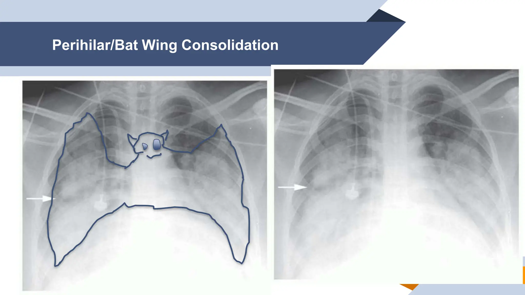 Imaging /radiographic findings of Lung Densities.pptx
