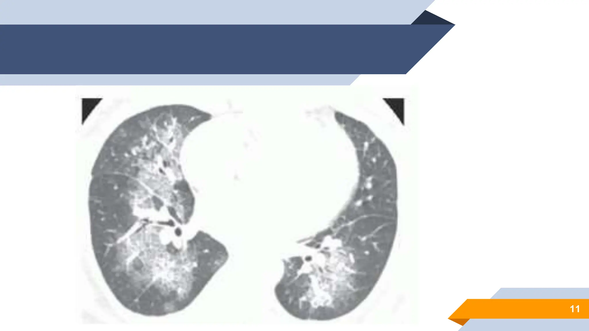 Imaging /radiographic findings of Lung Densities.pptx