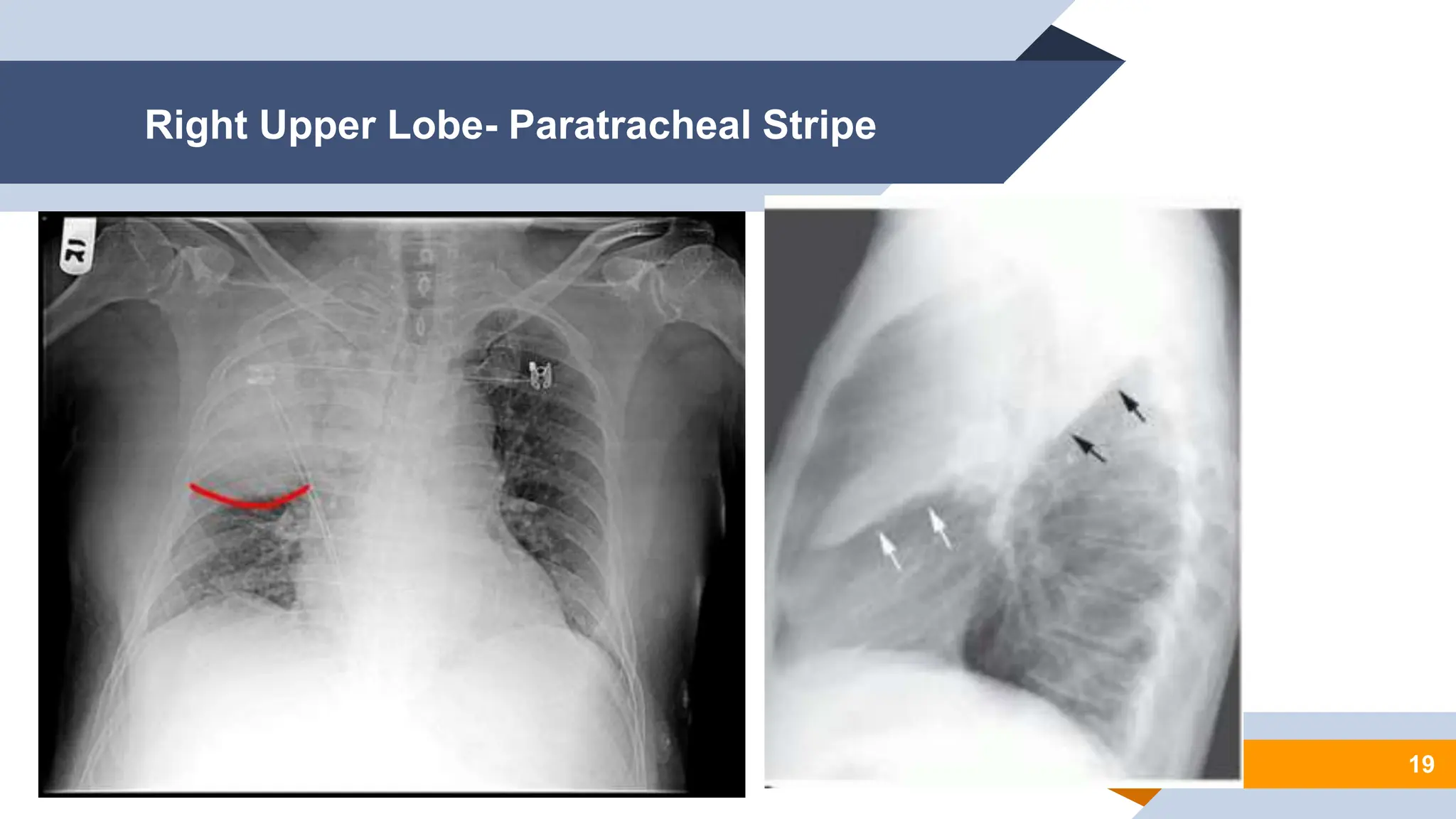 Imaging /radiographic findings of Lung Densities.pptx