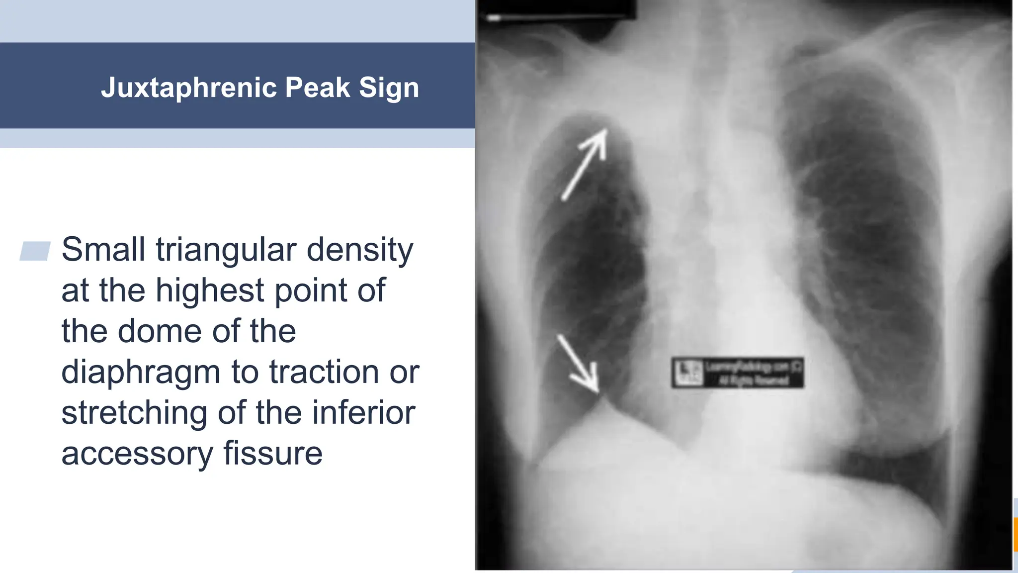 Imaging /radiographic findings of Lung Densities.pptx