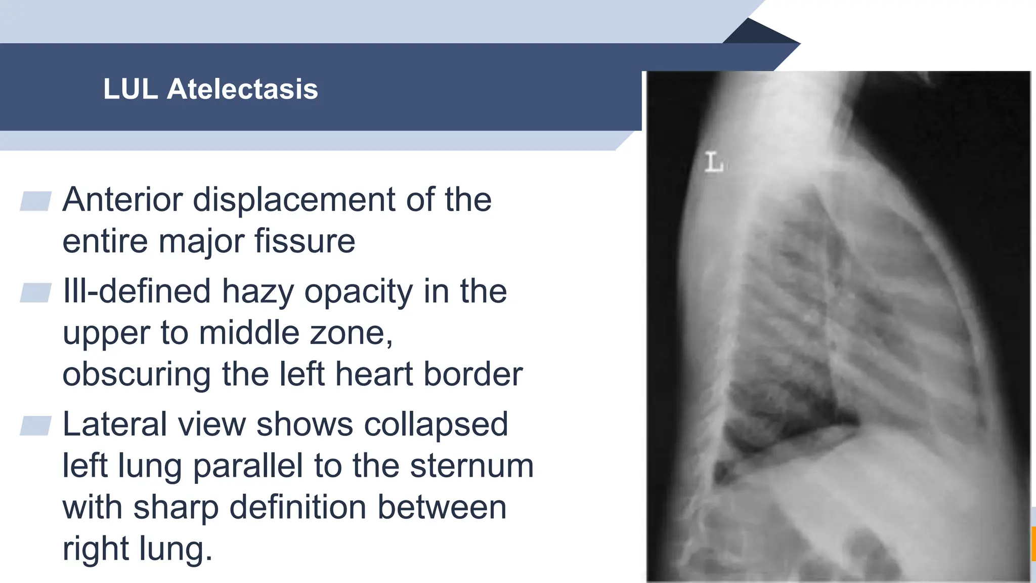 Imaging /radiographic findings of Lung Densities.pptx