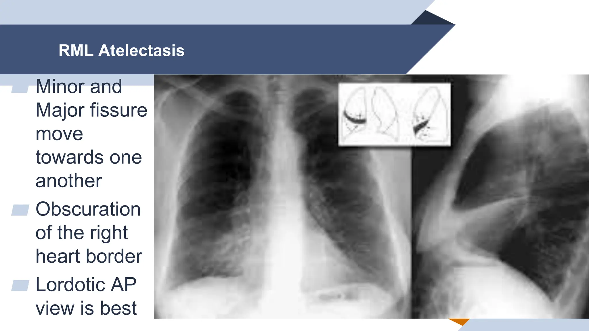 Imaging /radiographic findings of Lung Densities.pptx