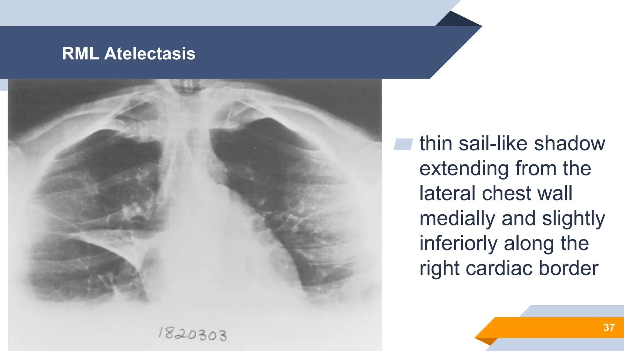 Imaging /radiographic findings of Lung Densities.pptx