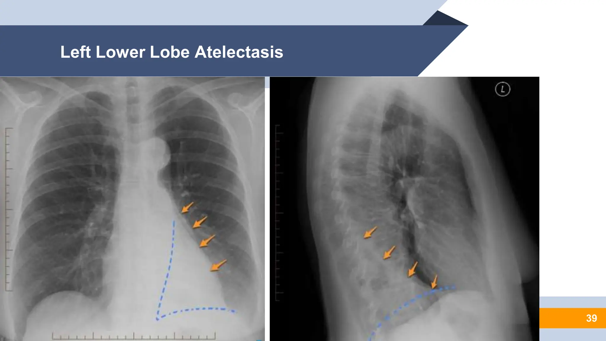Imaging /radiographic findings of Lung Densities.pptx