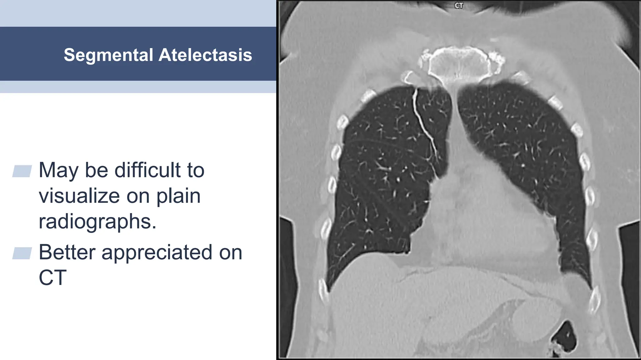 Imaging /radiographic findings of Lung Densities.pptx