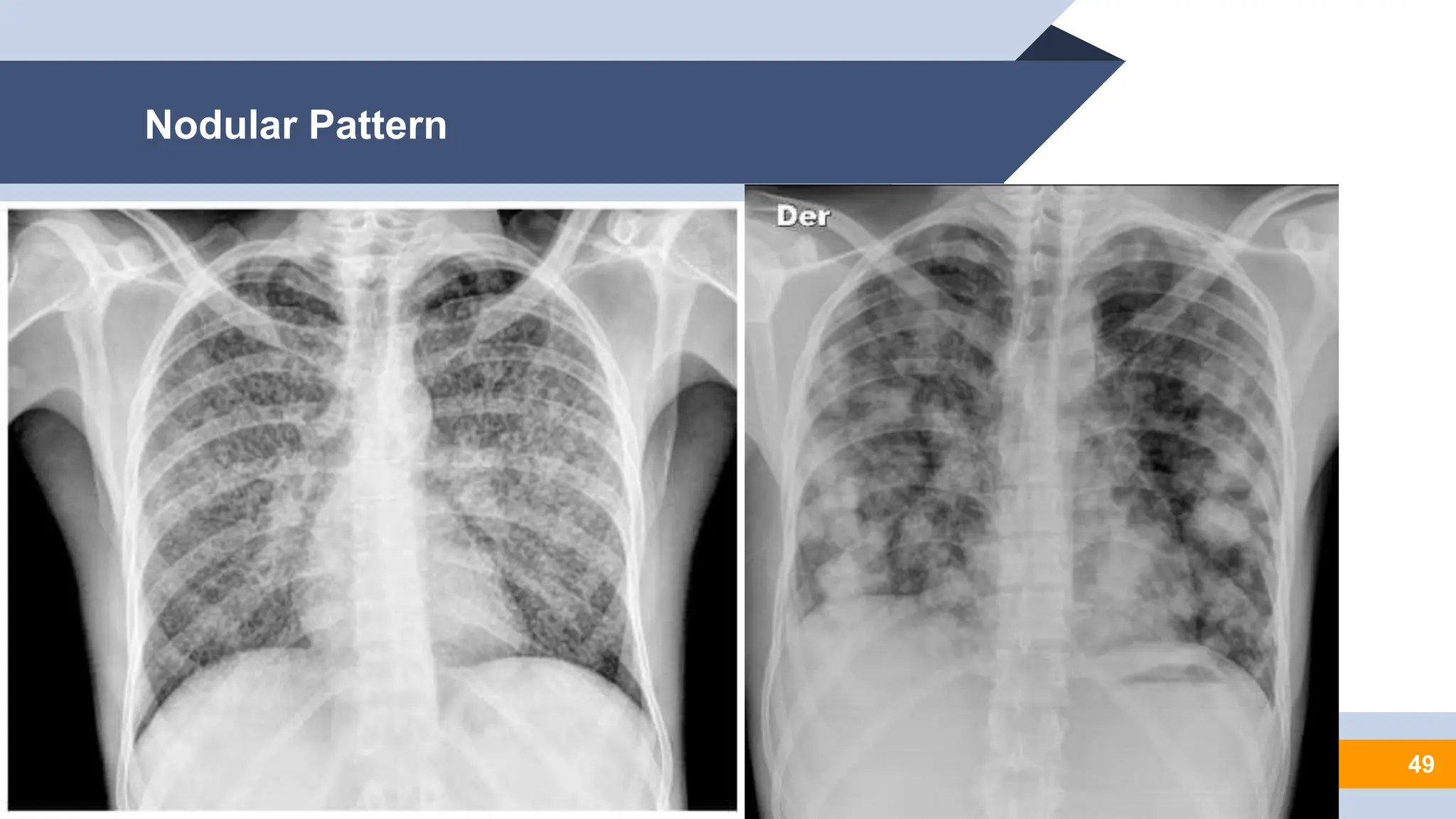 Imaging /radiographic findings of Lung Densities.pptx