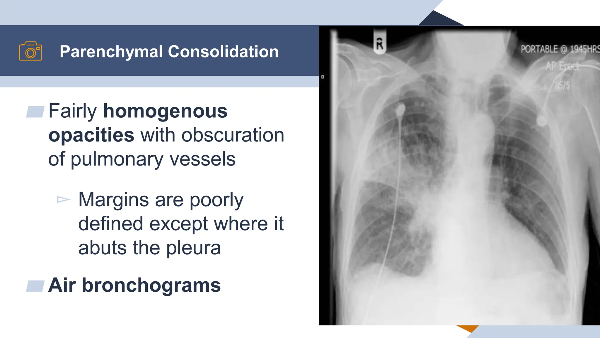 Imaging /radiographic findings of Lung Densities.pptx