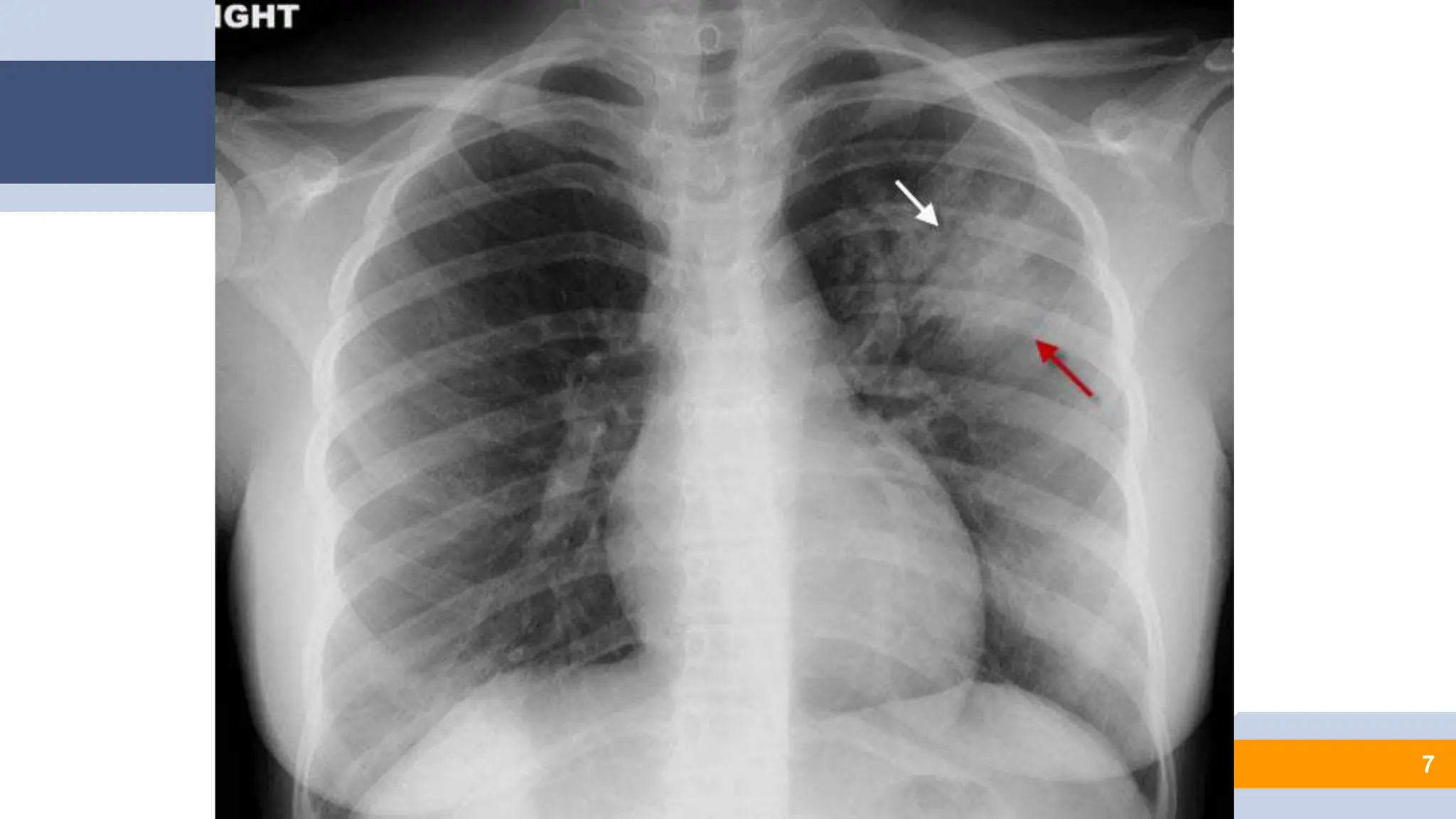 Imaging /radiographic findings of Lung Densities.pptx