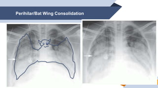 Imaging Radiographic Findings Of Lung Densitiespptx