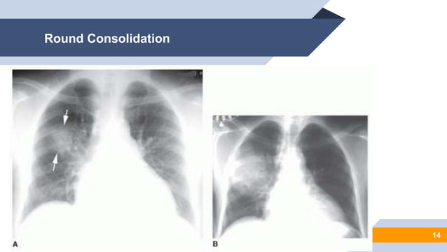 Imaging /radiographic findings of Lung Densities.pptx