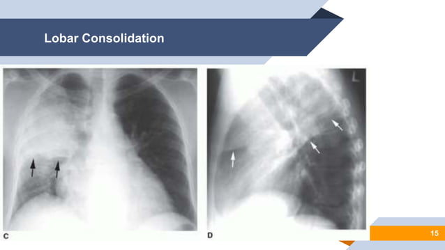 Imaging /radiographic findings of Lung Densities.pptx