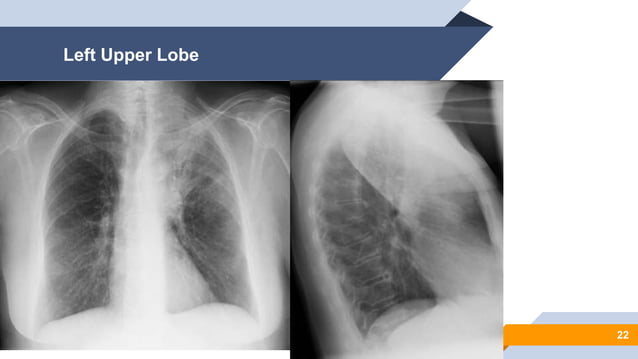 Imaging /radiographic findings of Lung Densities.pptx