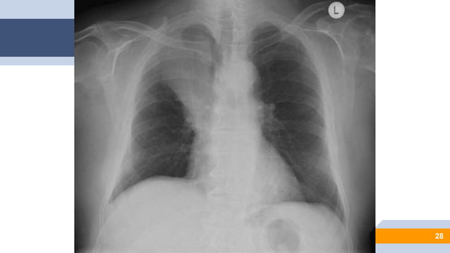 Imaging /radiographic findings of Lung Densities.pptx