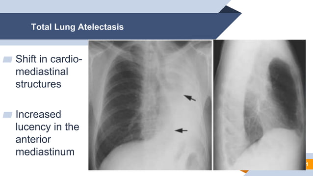 Imaging /radiographic findings of Lung Densities.pptx