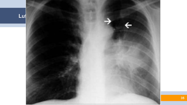 Imaging /radiographic findings of Lung Densities.pptx