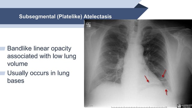 Imaging /radiographic findings of Lung Densities.pptx