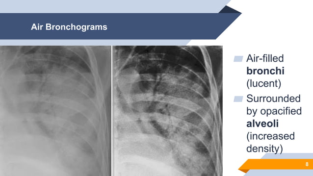 Imaging /radiographic findings of Lung Densities.pptx