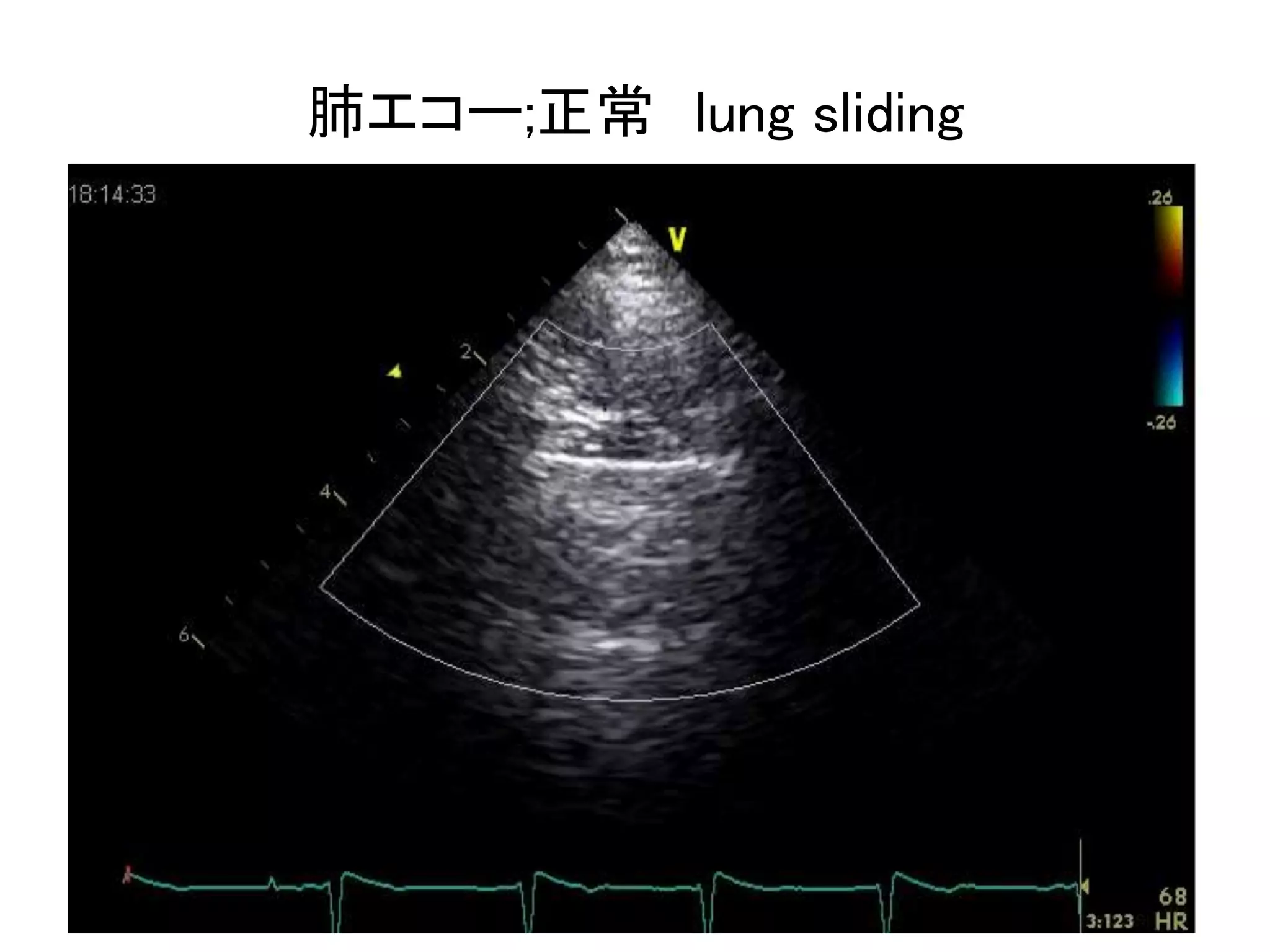 Lung echo for slideshare | PPT