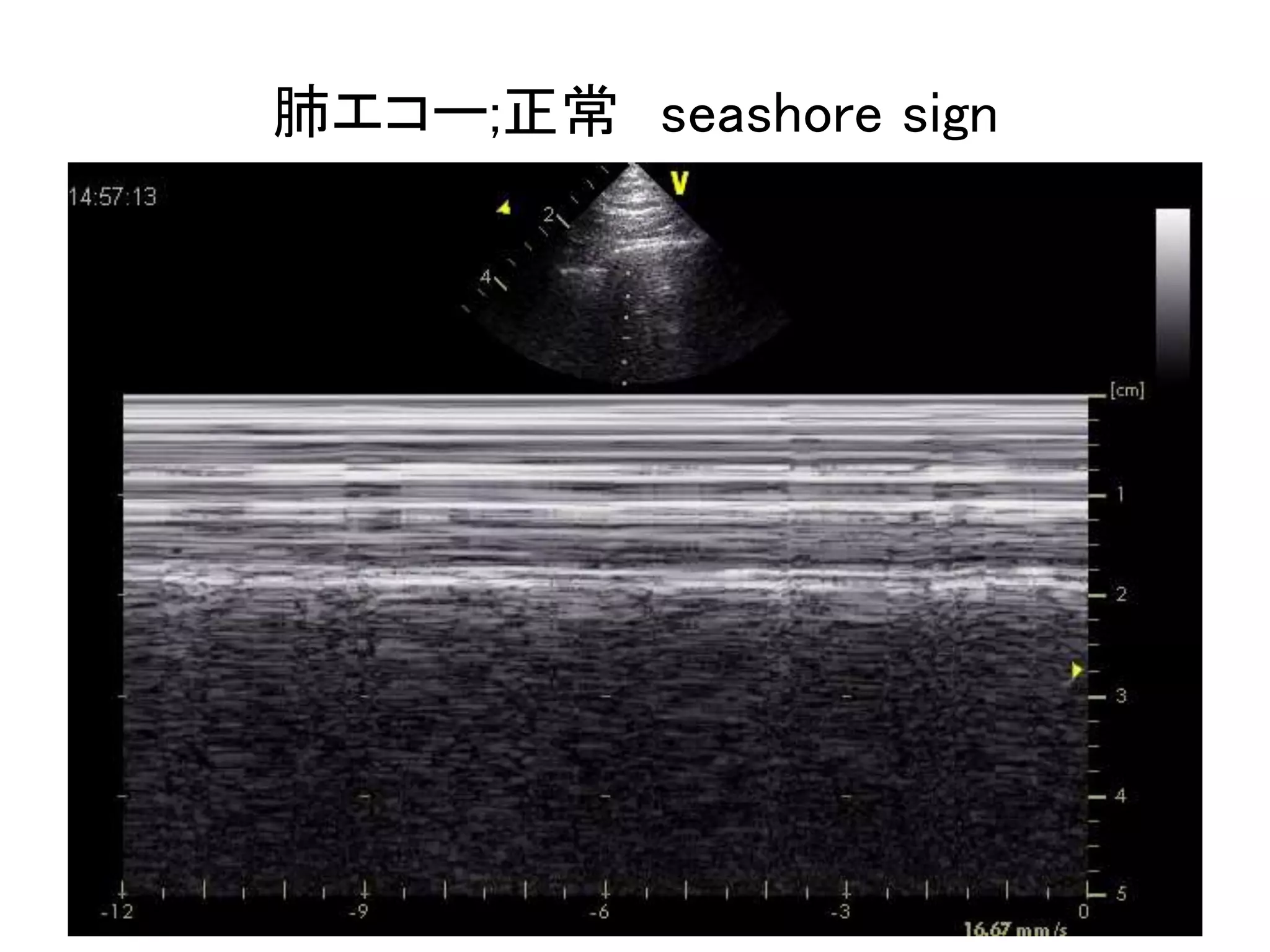 Lung echo for slideshare | PPT