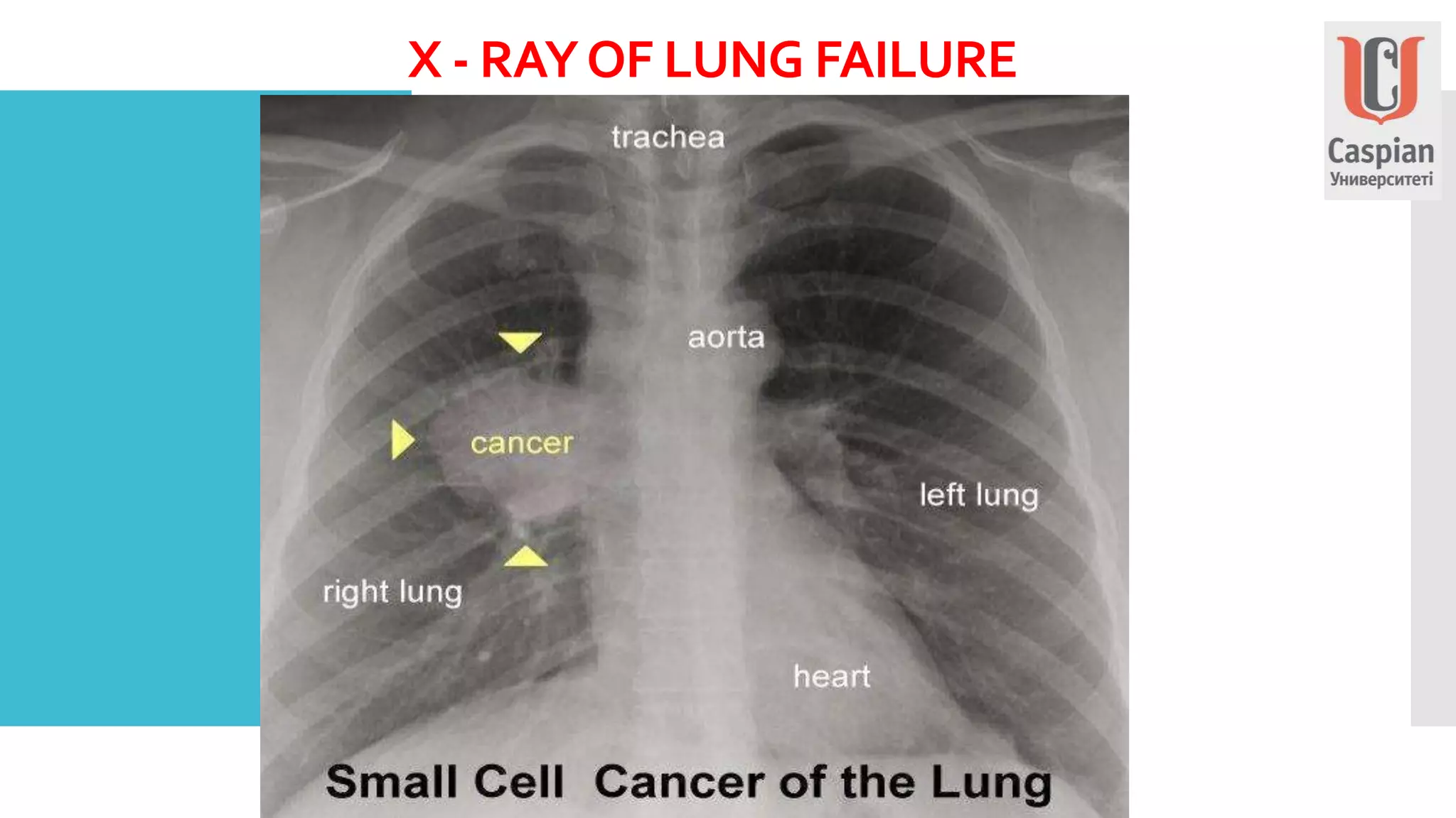 Lung Failure And AORTIC INSUFFICIENCY.pptx