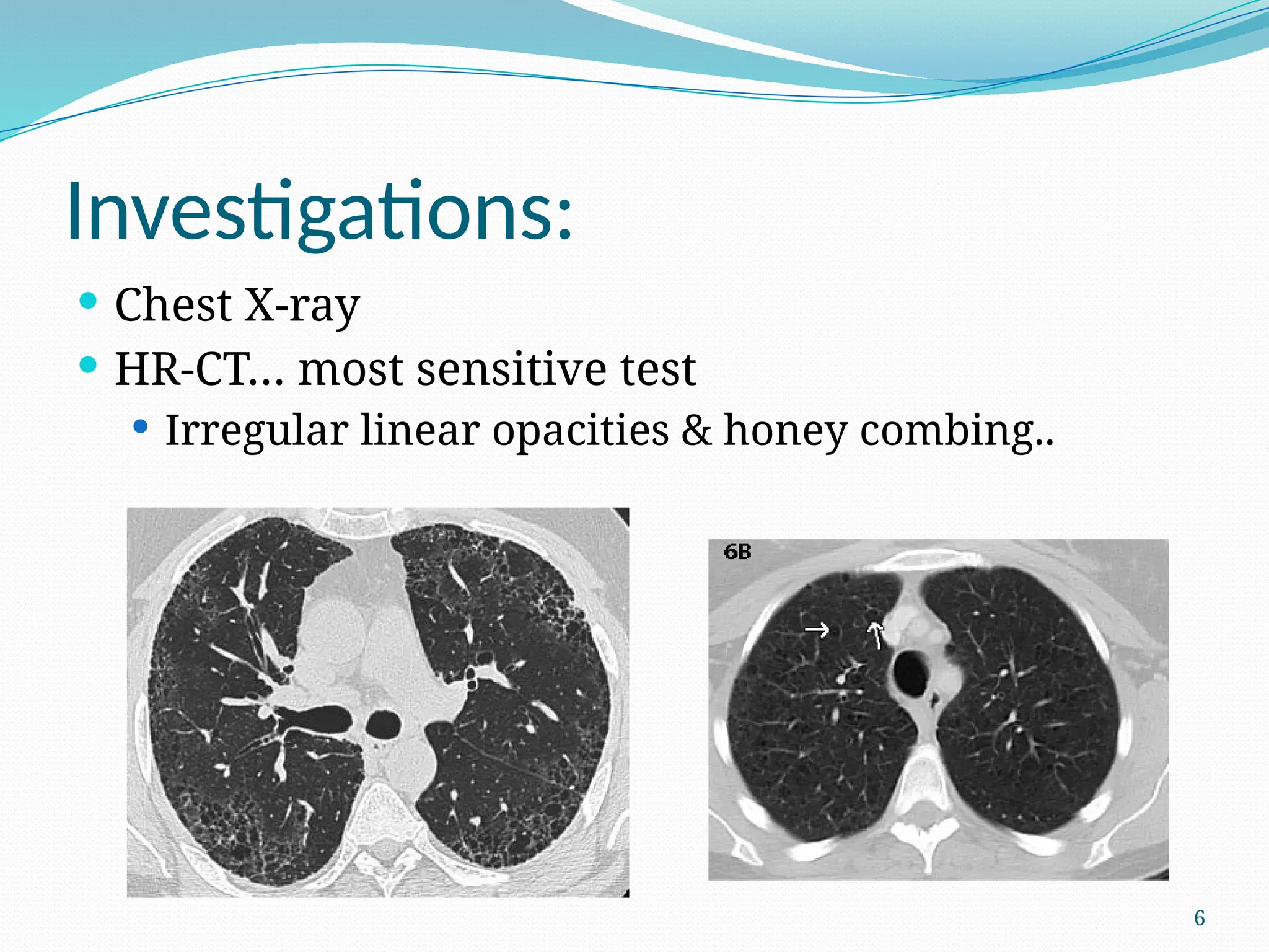 Lung fibrosis.pptx lungs fibrosis , pulmo | PPT