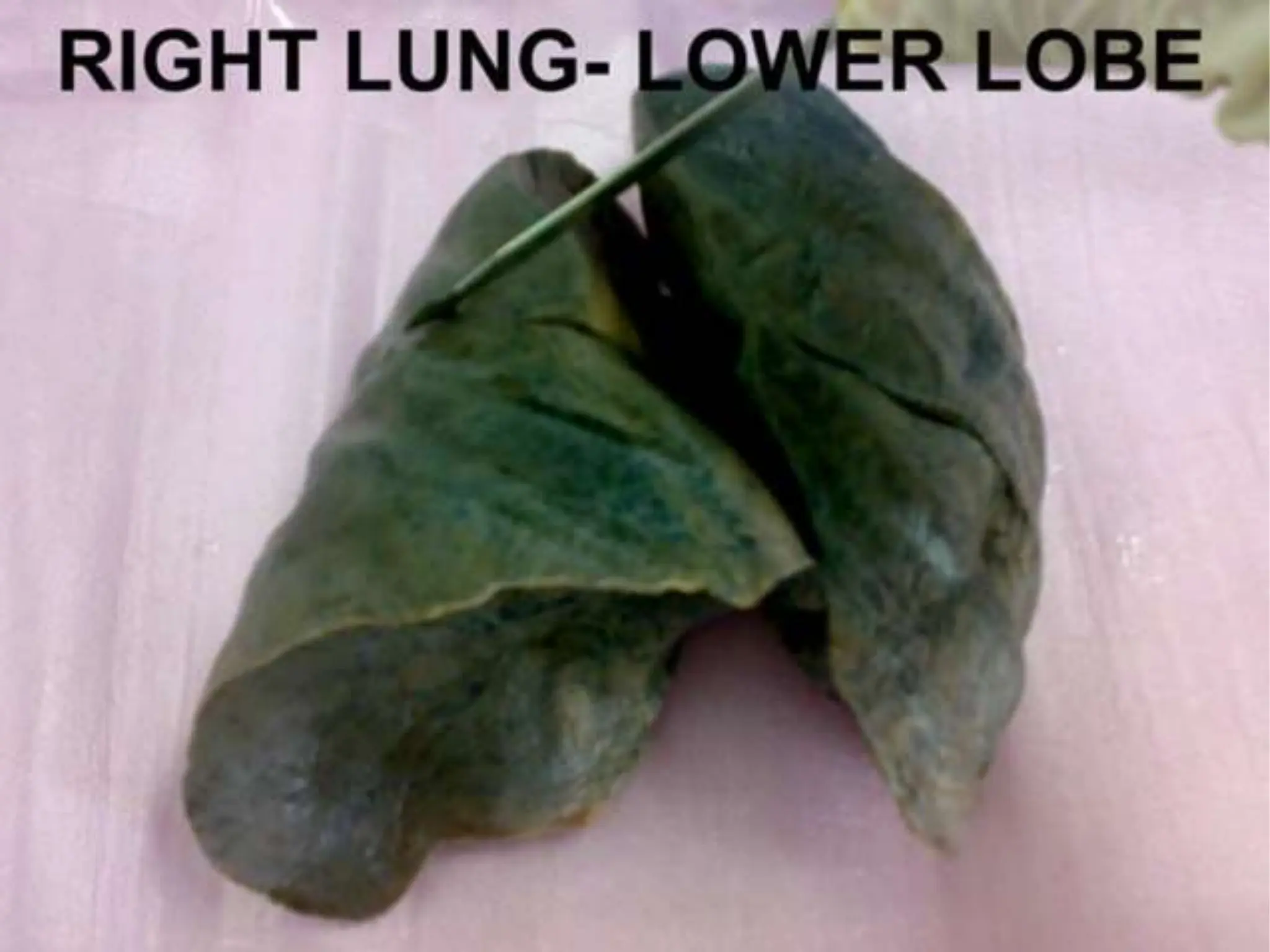 presentation of aotopsy of LUNG GROSSING .pptx