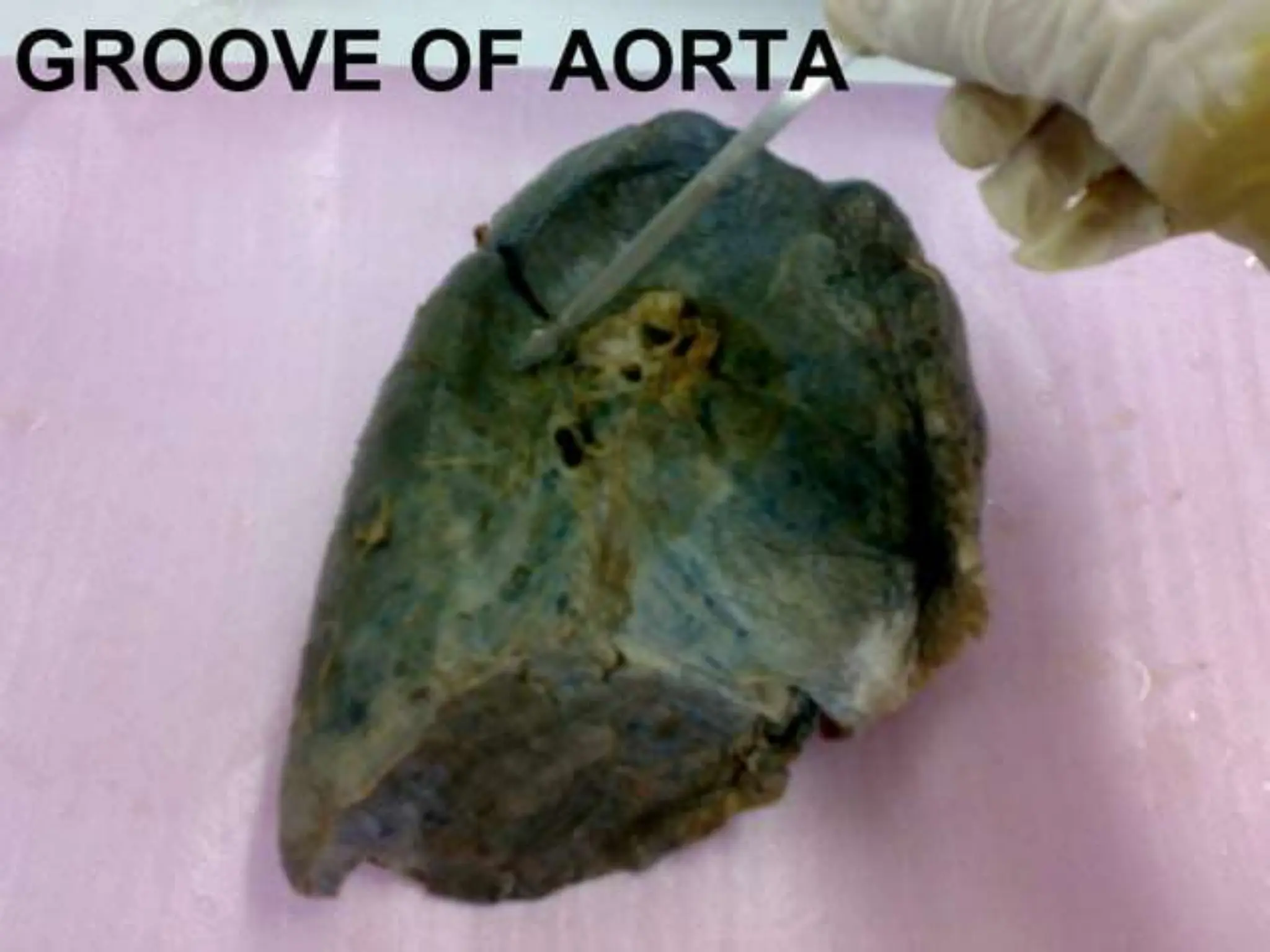 presentation of aotopsy of LUNG GROSSING .pptx
