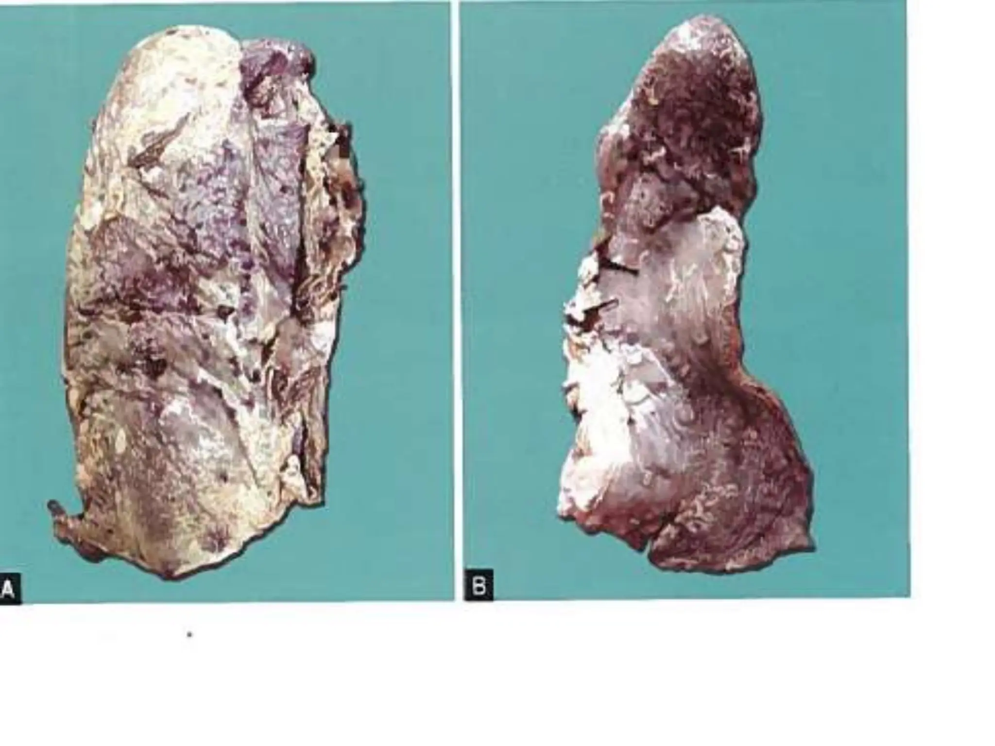 presentation of aotopsy of LUNG GROSSING .pptx