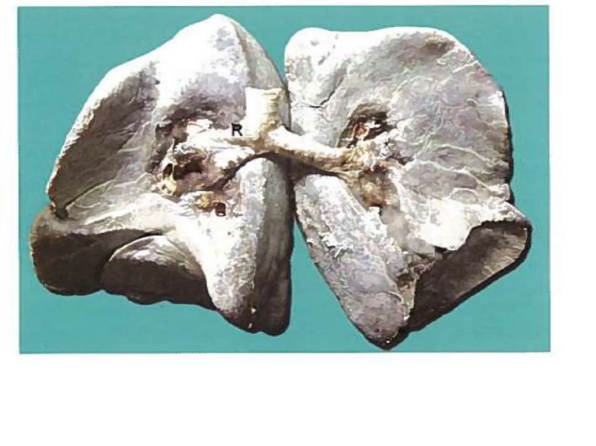 presentation of aotopsy of LUNG GROSSING .pptx