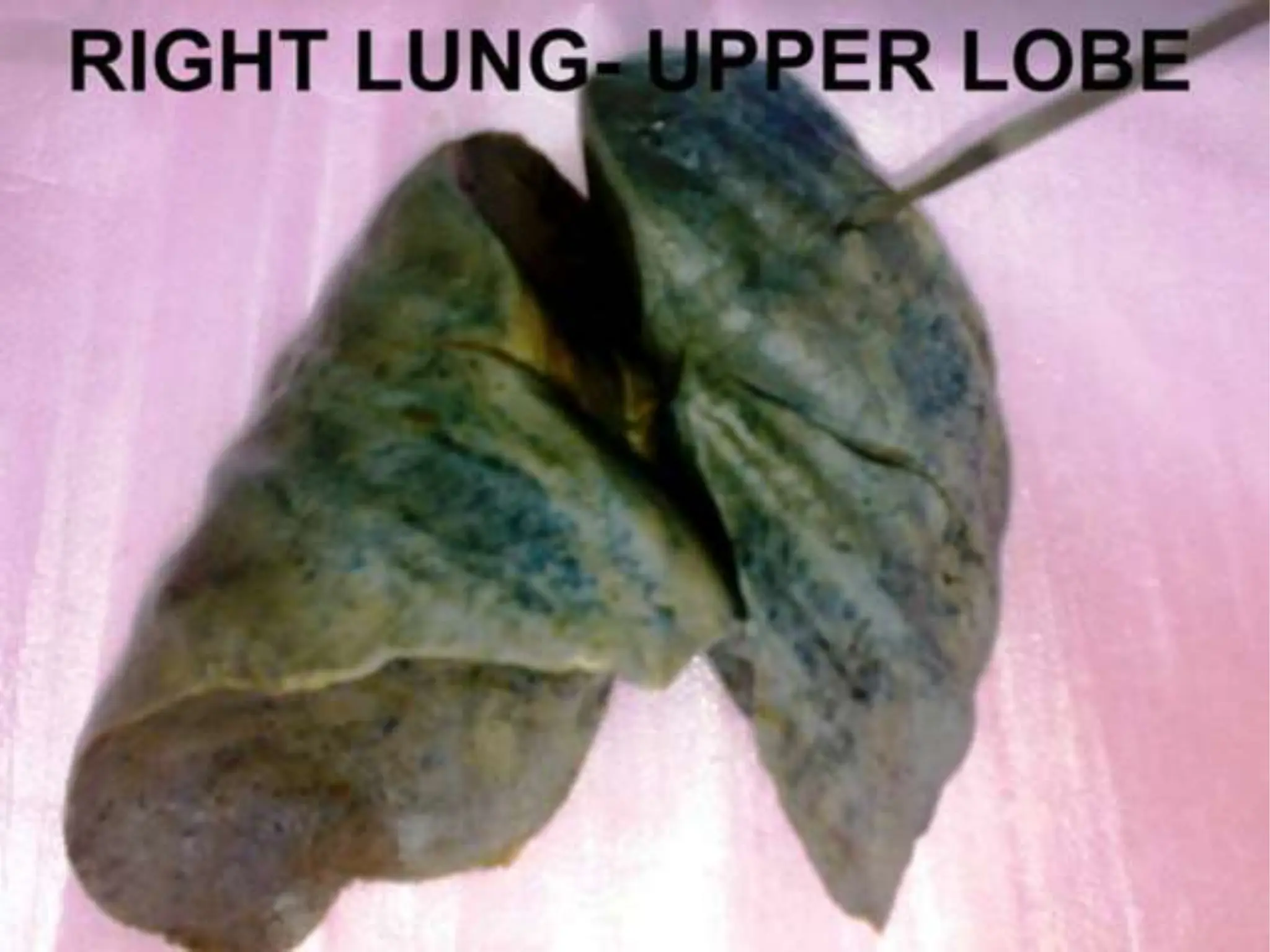 presentation of aotopsy of LUNG GROSSING .pptx