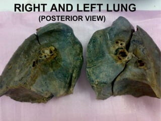 presentation of aotopsy of LUNG GROSSING .pptx
