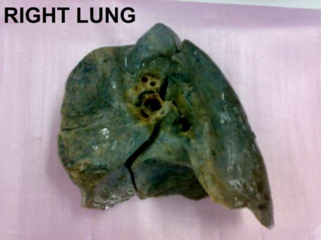 presentation of aotopsy of LUNG GROSSING .pptx