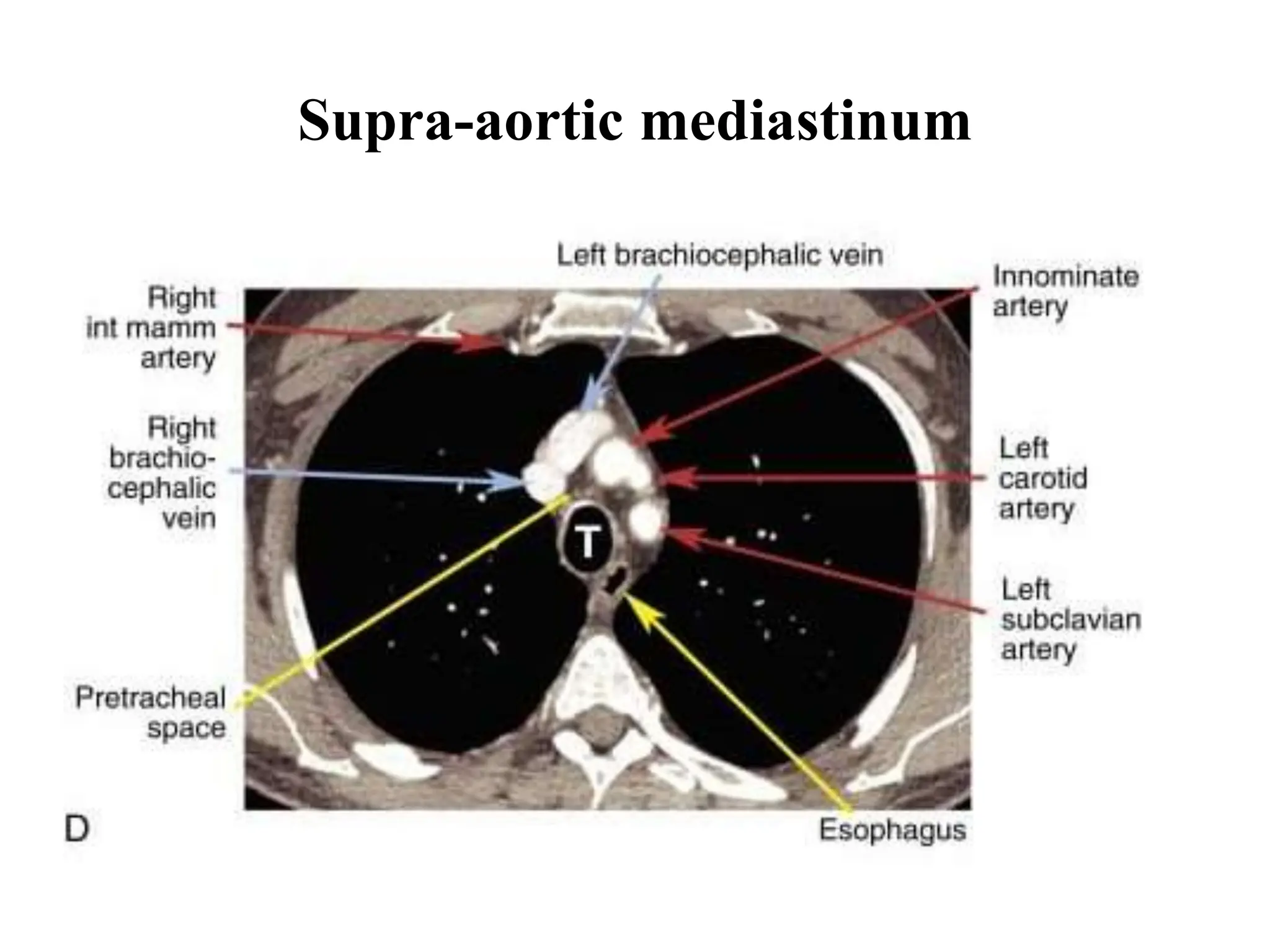 LUNG IMAGING CT SCAN with classification.pptx